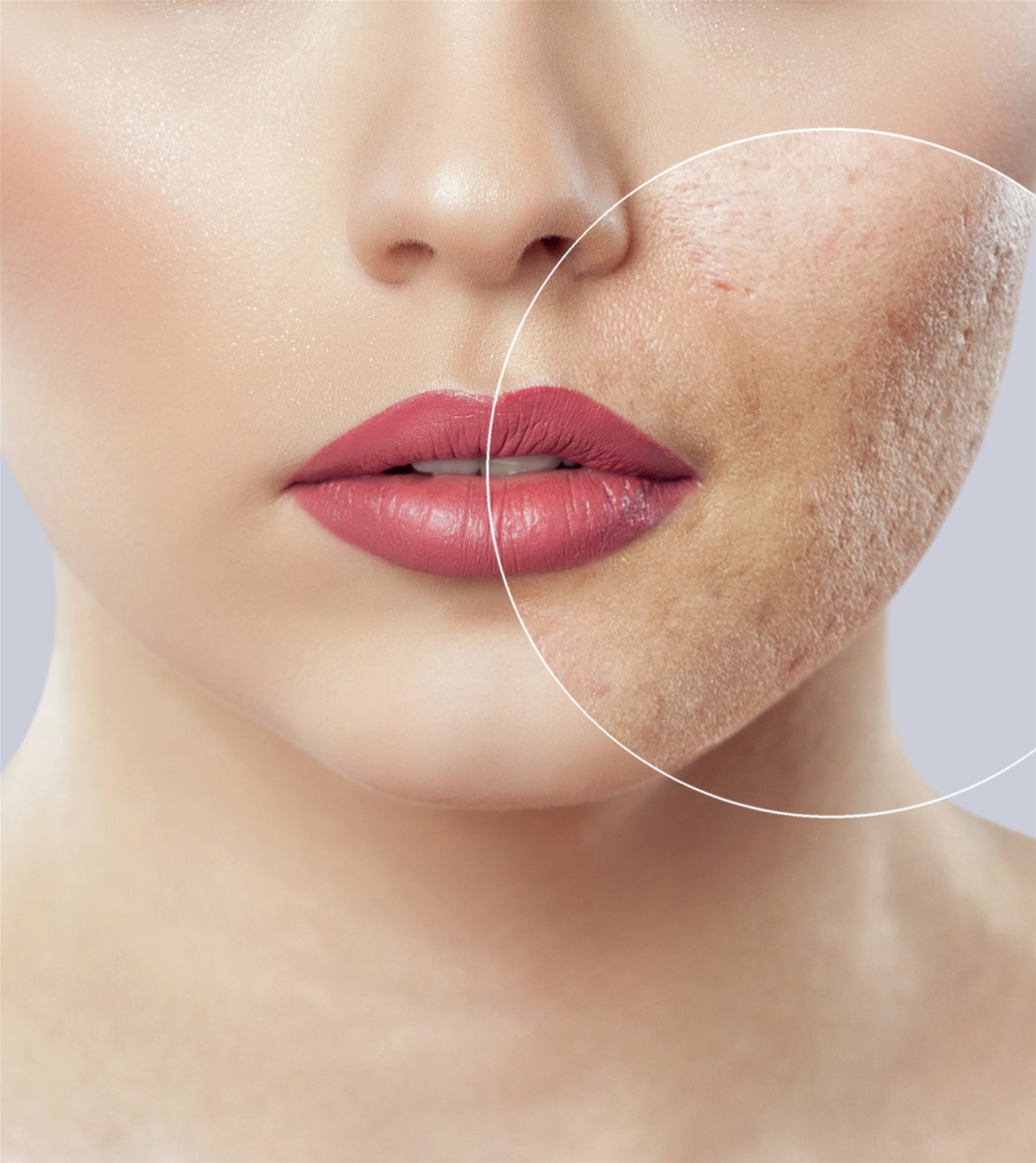Use Of Dermal Fillers In Atrophic Acne Scarring Aesthetic Medicine April 2024